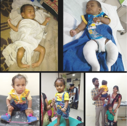 187 Childrens suffering from Club Foot cured in GKGH during last three ...
